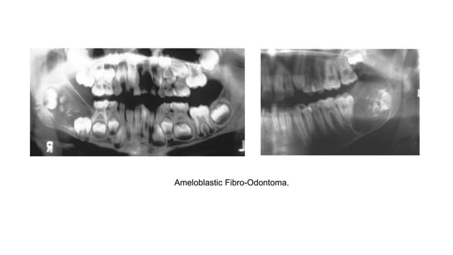 1. Ameloblastic fibroma 2. Odontoma 3. Squamous odontogenic tumor | PPTX
