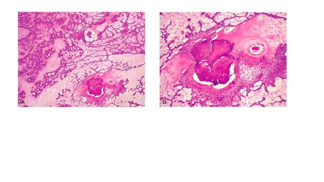 1. Ameloblastic fibroma 2. Odontoma 3. Squamous odontogenic tumor | PPTX