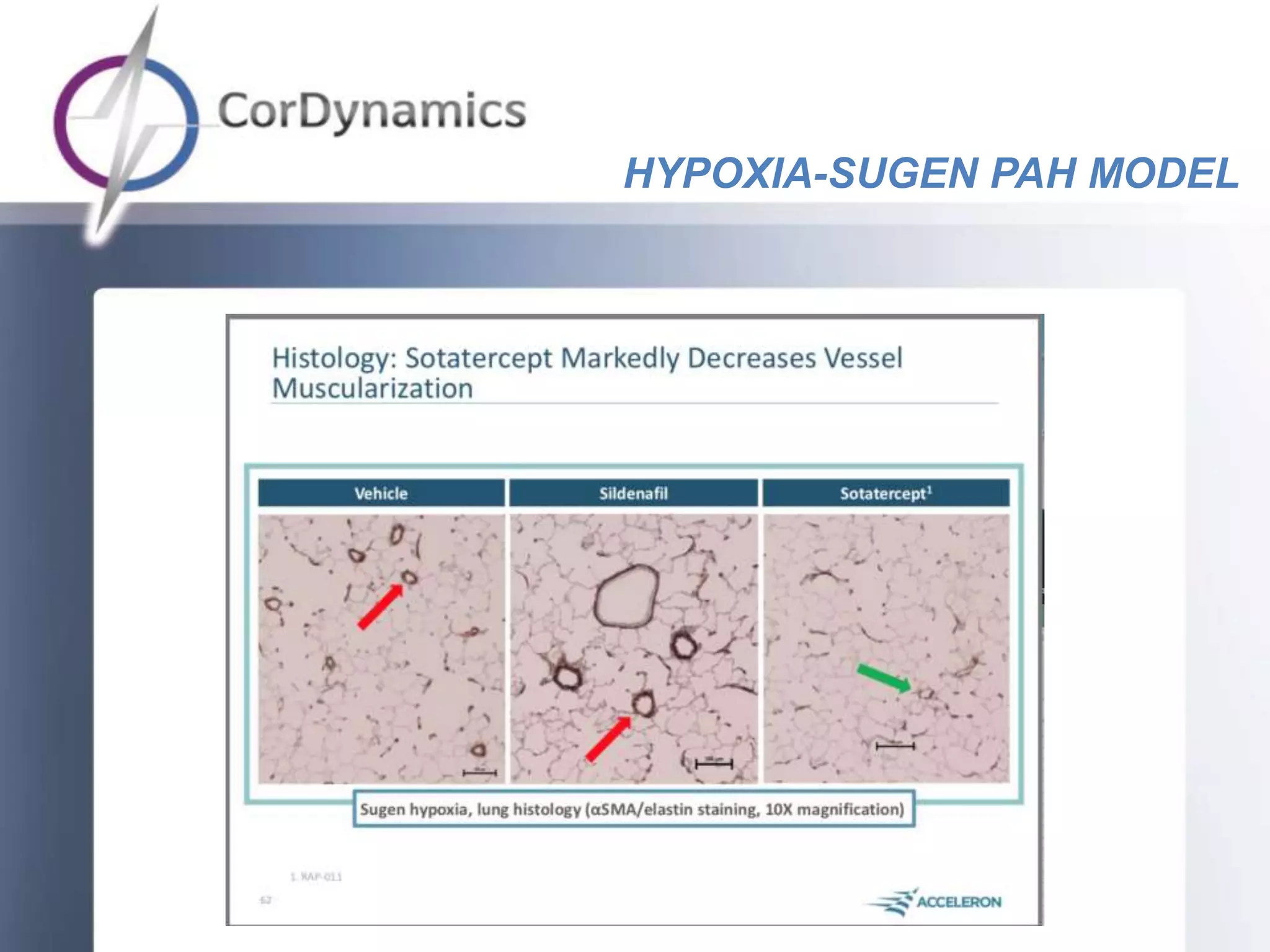 Sotatercept for Hypoxia Sugen PAH at CorDynamics | PPTX