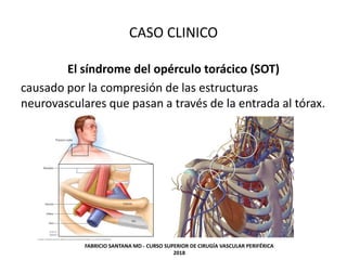 SINDROME DEL OPERCULO TORACICO MD SANTANA MENDOZA FABRICIO 2018 | PPTX