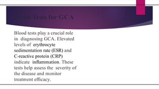 Soumya Ray - Giant cell arteritis in Human | PPTX