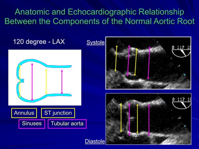 SINUS OF VALSALVA ANEURYSM | PPTX | Heart and Cardiovascular Diseases ...