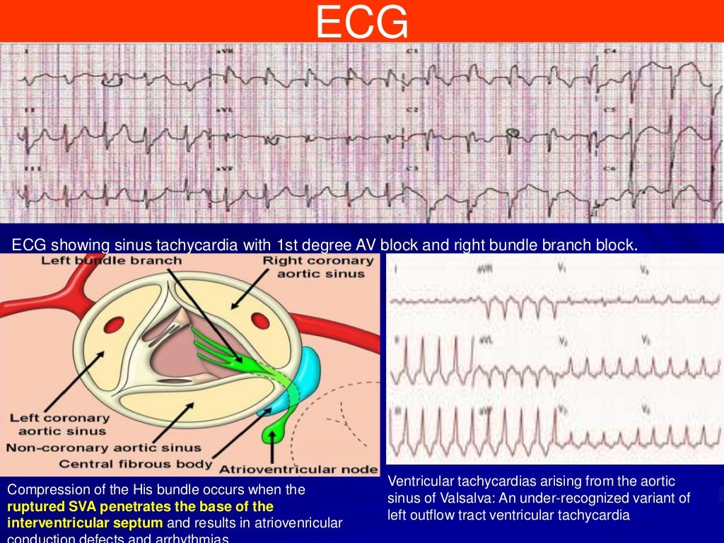 SINUS OF VALSALVA ANEURYSM