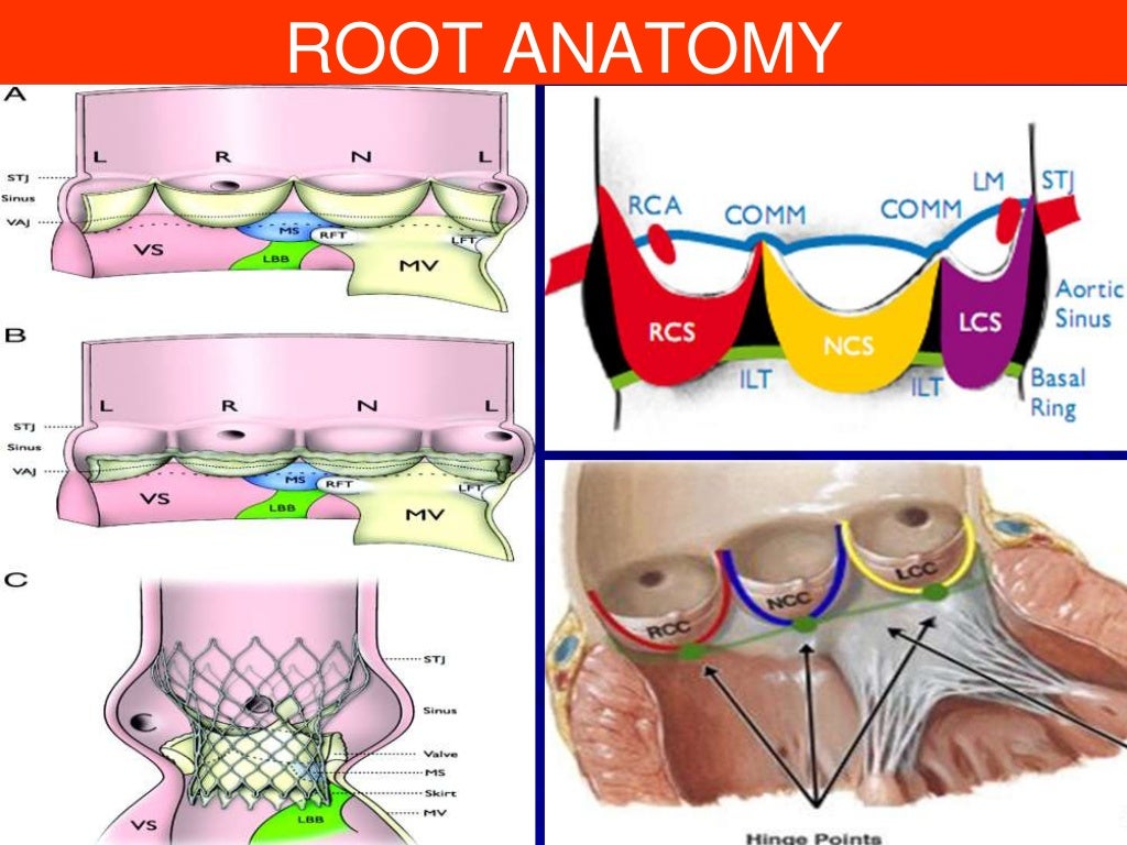 SINUS OF VALSALVA ANEURYSM