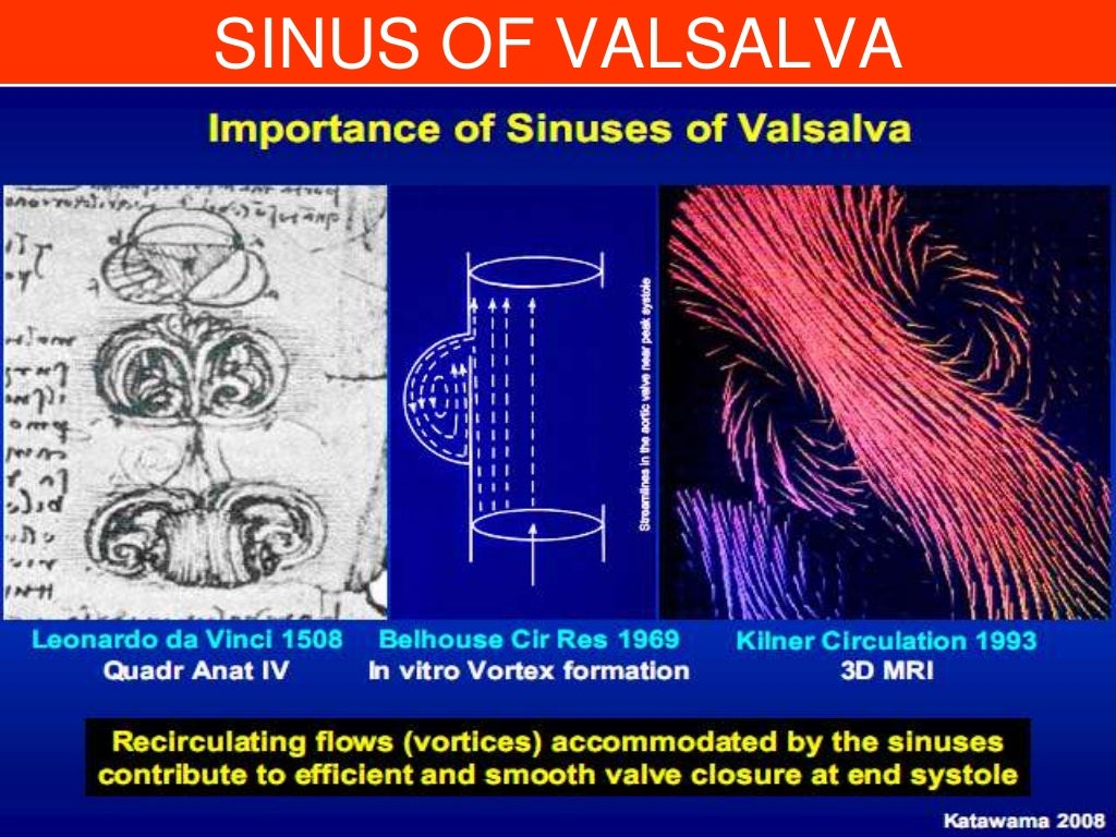 SINUS OF VALSALVA ANEURYSM