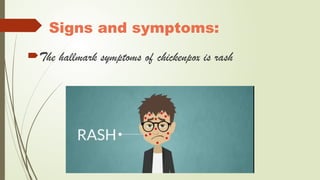 Sowmiya _Chicken pox_varicella_zoster_virus.pptx