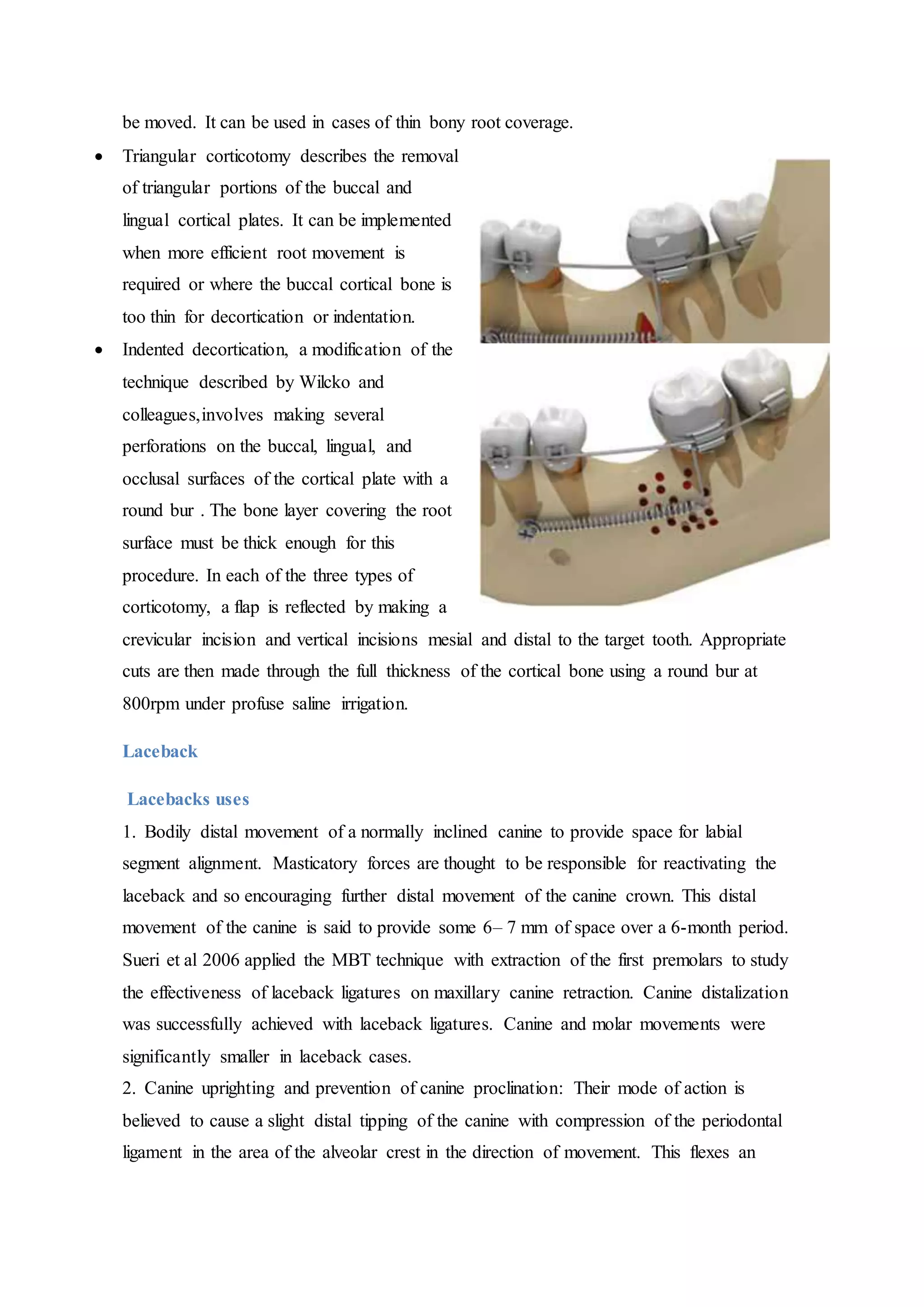 Space closure for orthodontists by Almuzian | DOCX