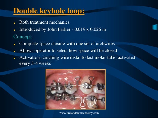 Space closure by frictionless mechanics 2 /certified fixed orthodonti…