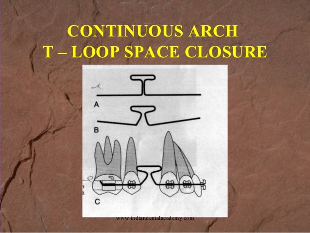 Space Closure Certified Fixed Orthodontic Courses By Indian Dental