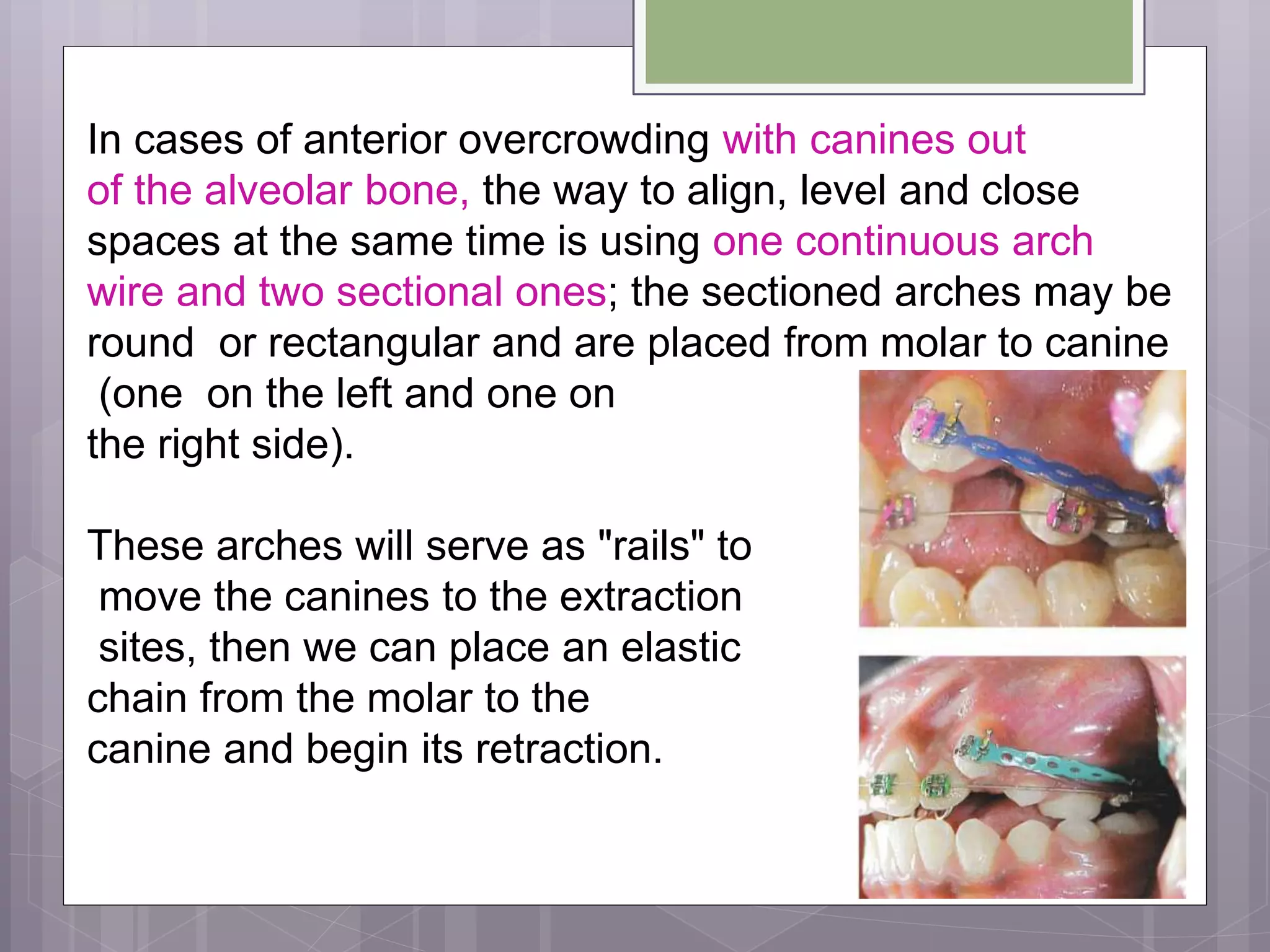 Space closure in orthdontics | PPTX