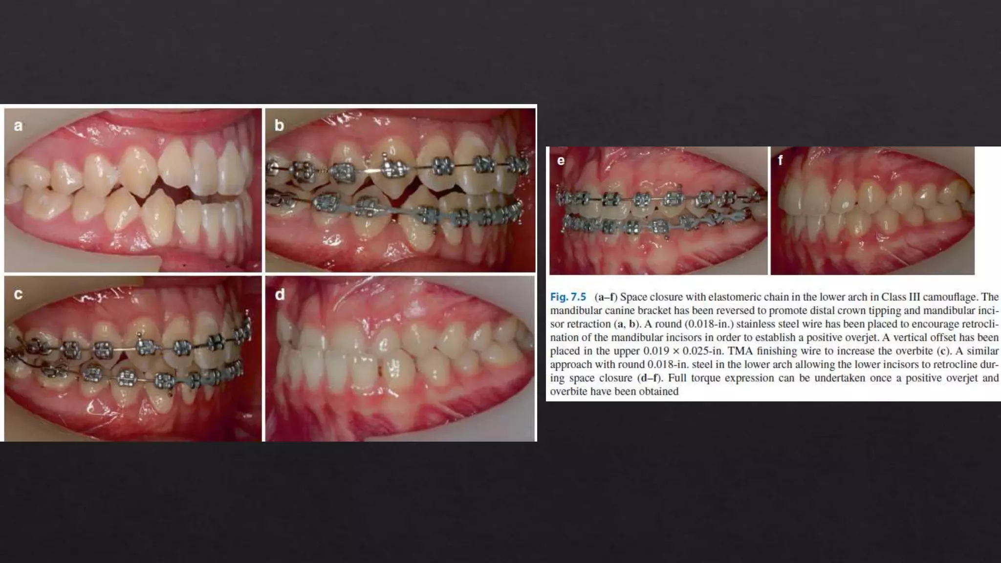 Space closure in orthodontics (dr nayaungbds phd) | PPTX
