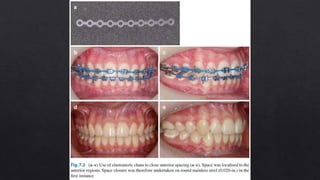 Space closure in orthodontics (dr nayaungbds phd) | PPTX