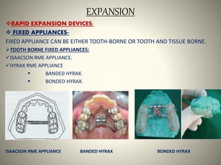 Space gaining methods -ORTHODONTICS | PPTX