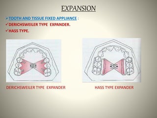 Space gaining methods -ORTHODONTICS | PPTX