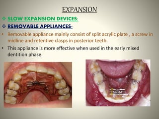 Space gaining methods -ORTHODONTICS | PPTX