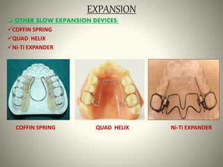 Space gaining methods -ORTHODONTICS | PPTX