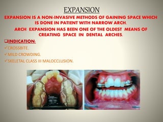 Space gaining methods -ORTHODONTICS | PPTX