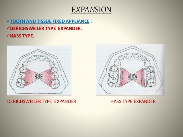 Space gaining methods -ORTHODONTICS