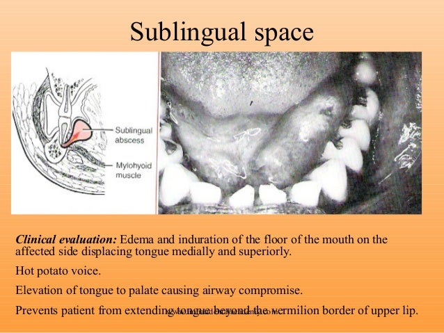 Space infection 2 /certified fixed orthodontic courses by Indian dent…