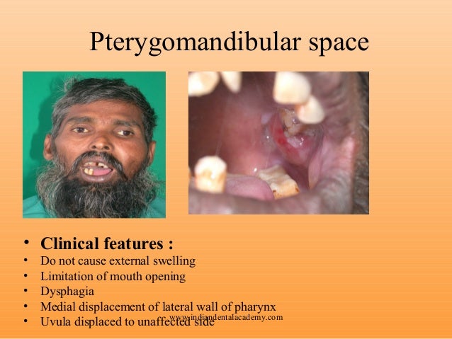 Infratemporal Space Displacement Tooth