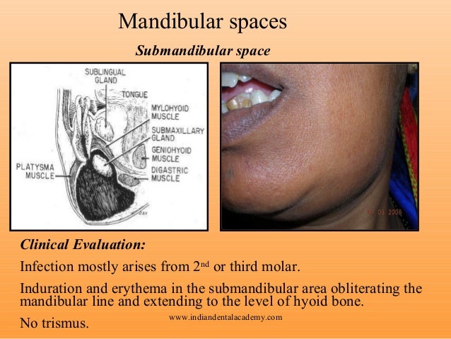 Space infection /certified fixed orthodontic courses by Indian dent…