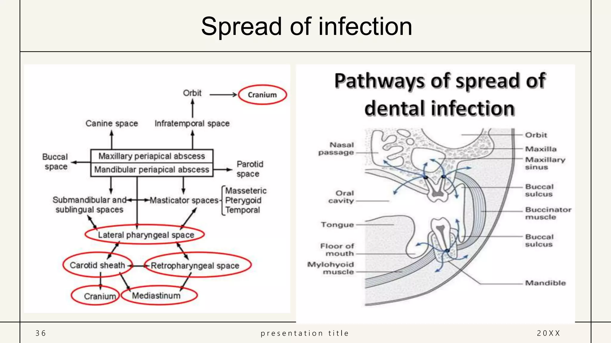 Fascial SPACE INFECTION | PPTX