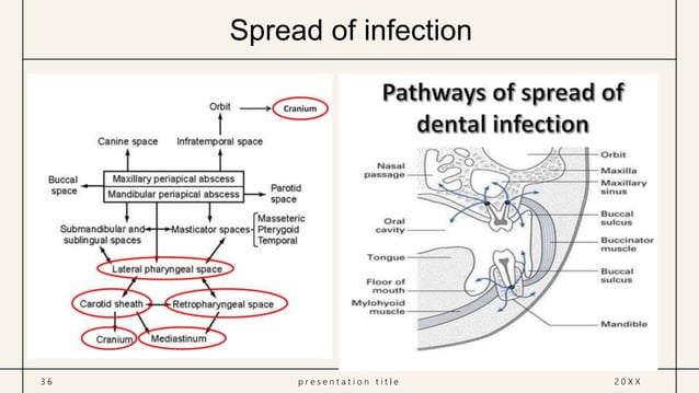 Fascial SPACE INFECTION | PPTX