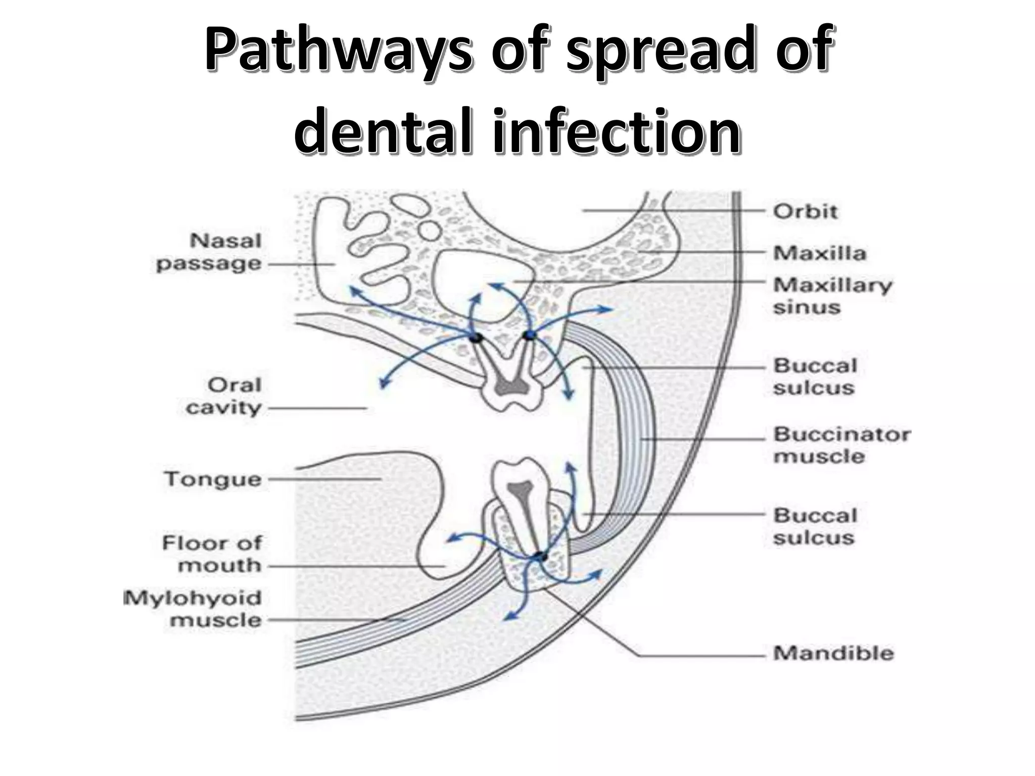 Maxillofacial space infections | PPTX