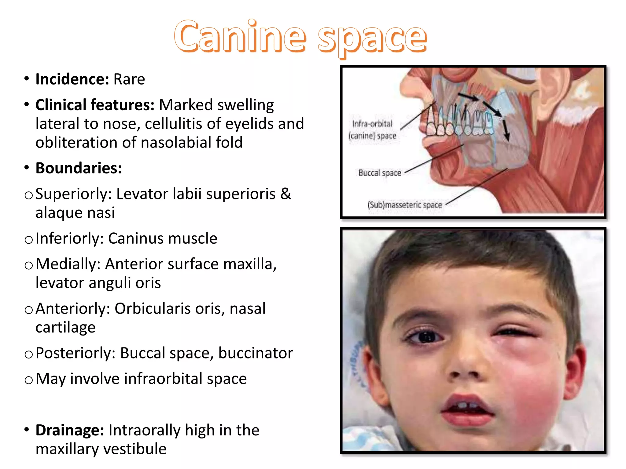 Maxillofacial space infections | PPTX