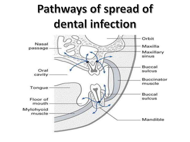 Maxillofacial space infections | PPTX | Dental Health | Diseases and ...