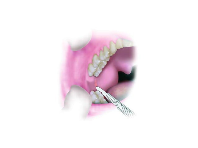 SPACE INFECTIONS | PPTX