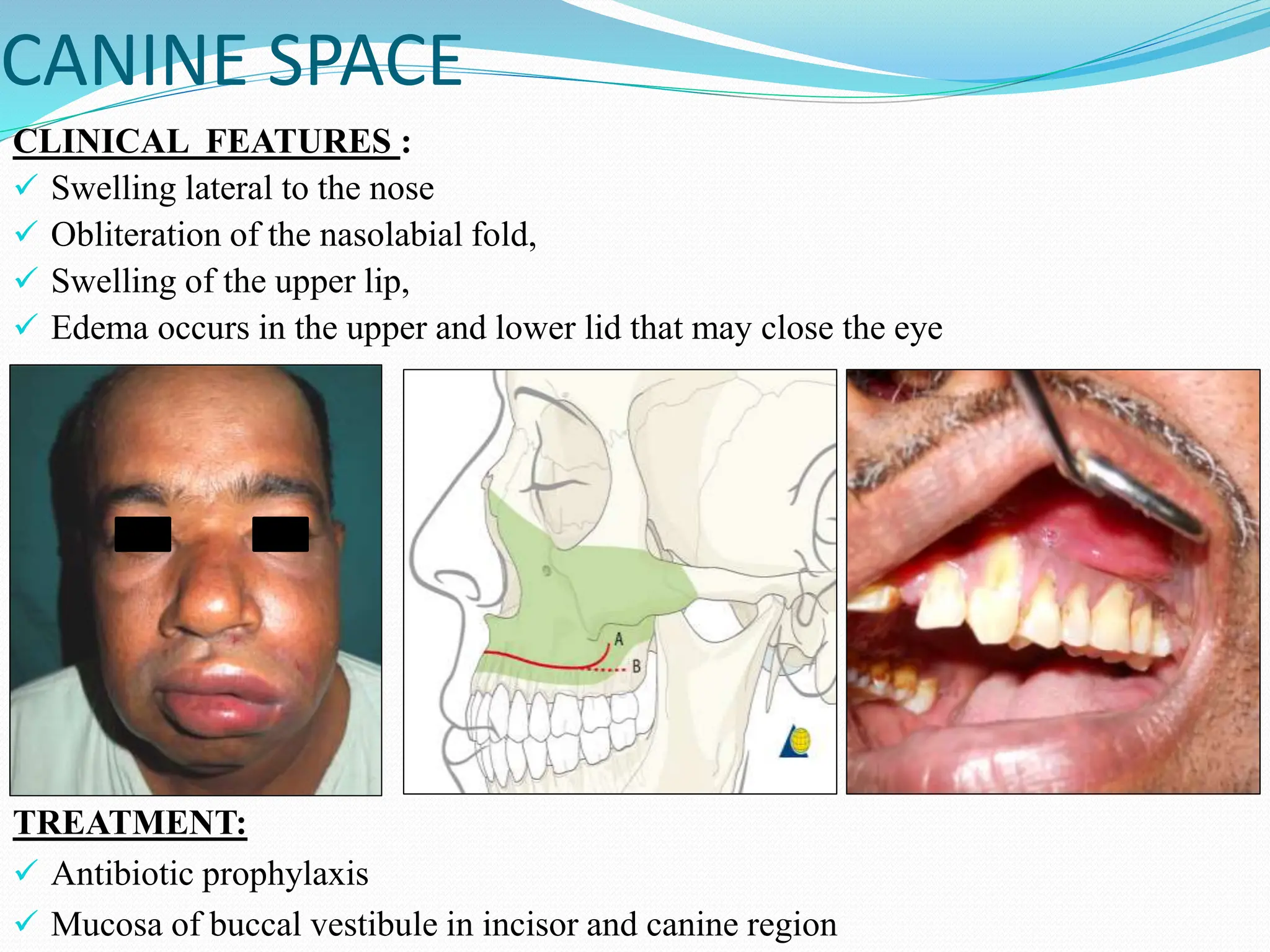 SPACE INFECTIONS-TYPES, DIAGNSOSIS AND MANAGEMENT | PPTX