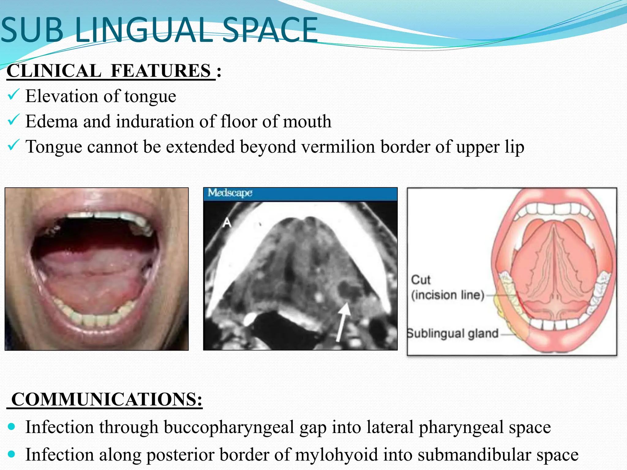 SPACE INFECTIONS-TYPES, DIAGNSOSIS AND MANAGEMENT | PPTX