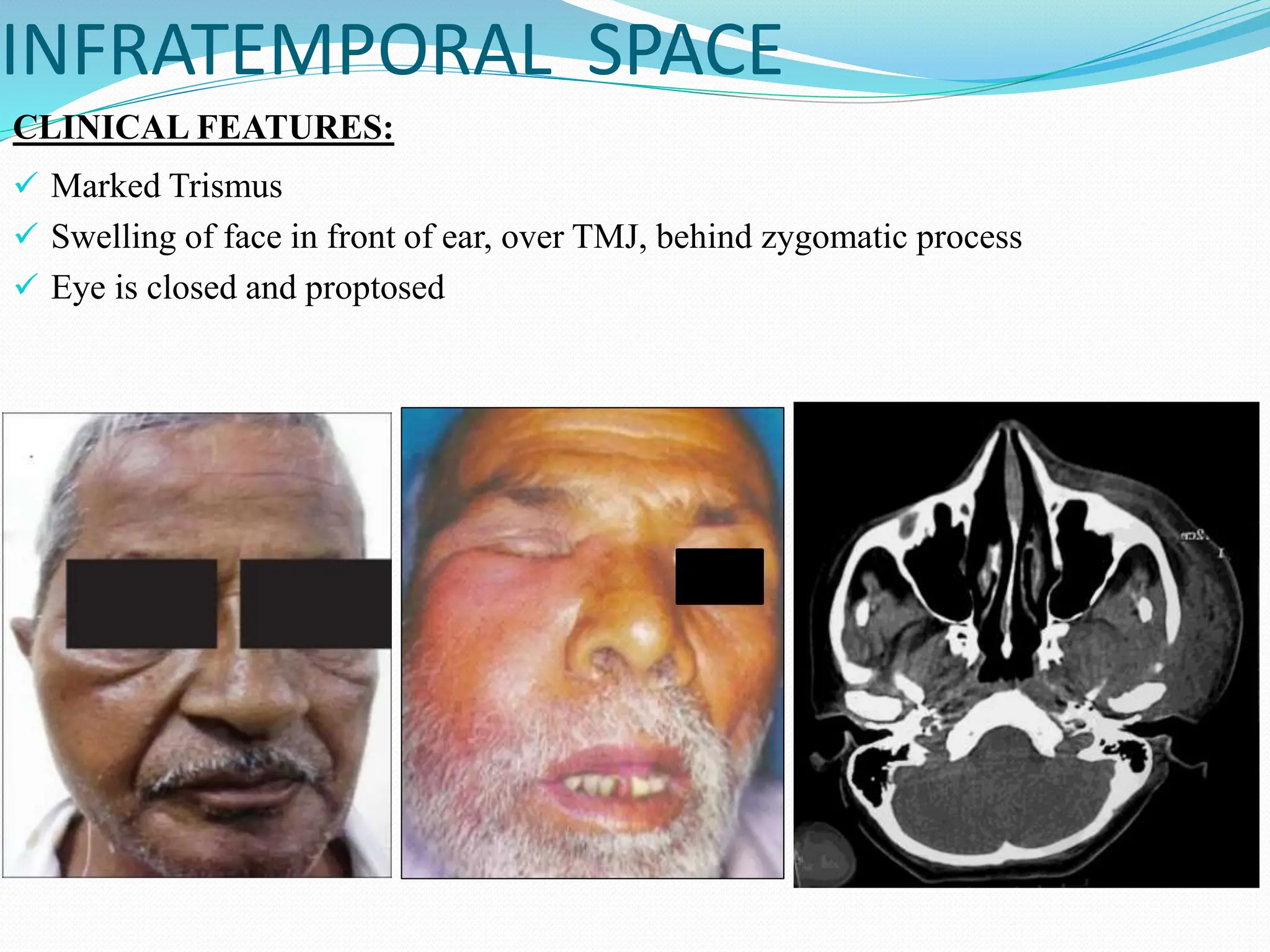 SPACE INFECTIONS-TYPES, DIAGNSOSIS AND MANAGEMENT | PPTX