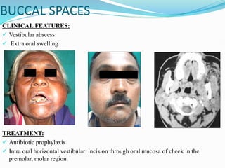 SPACE INFECTIONS-TYPES, DIAGNSOSIS AND MANAGEMENT | PPTX