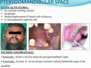SPACE INFECTIONS-TYPES, DIAGNSOSIS AND MANAGEMENT | PPTX