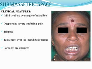 SPACE INFECTIONS-TYPES, DIAGNSOSIS AND MANAGEMENT | PPTX