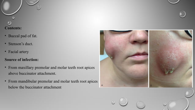 SPACE INFECTIONS.pptx of head and neck description | PPT