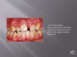 Space loss and crowding | PPTX