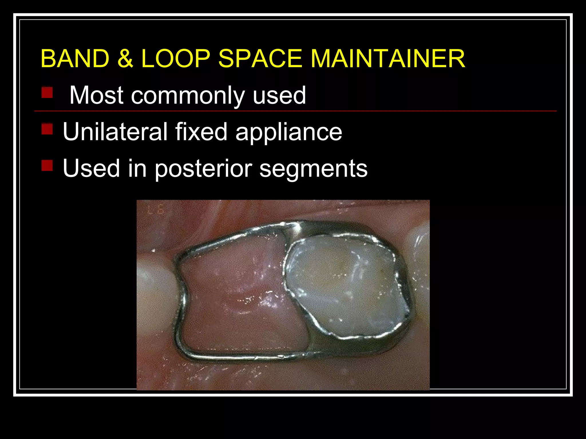 Space maintainer | PPT