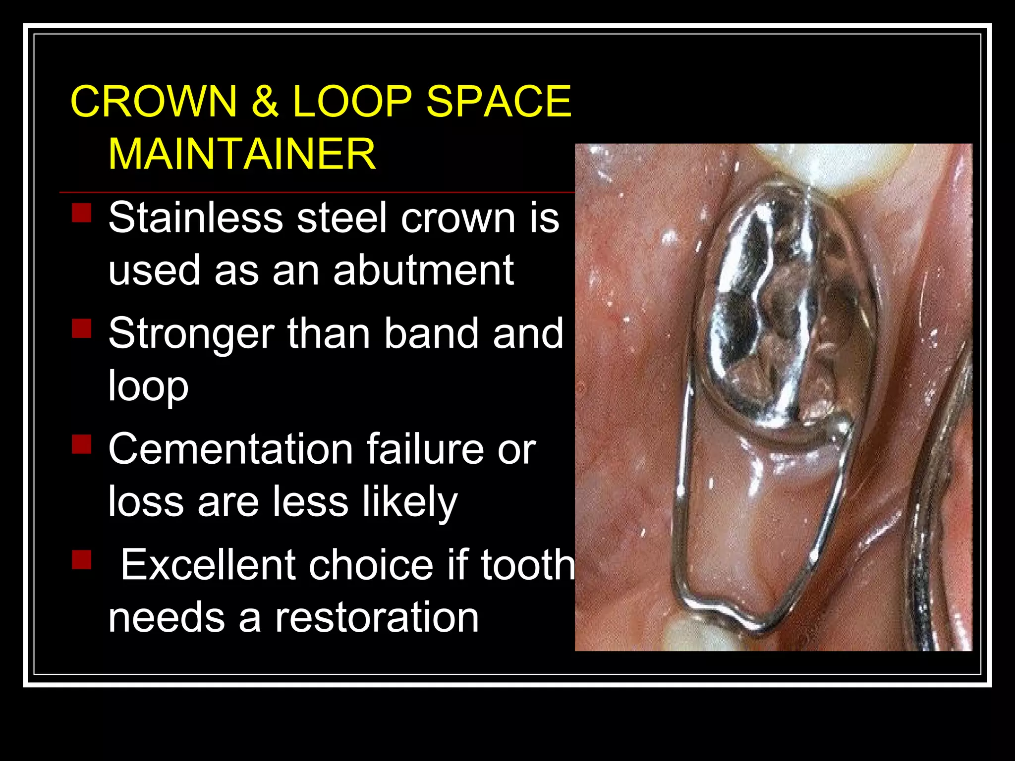 Space maintainer | PPT