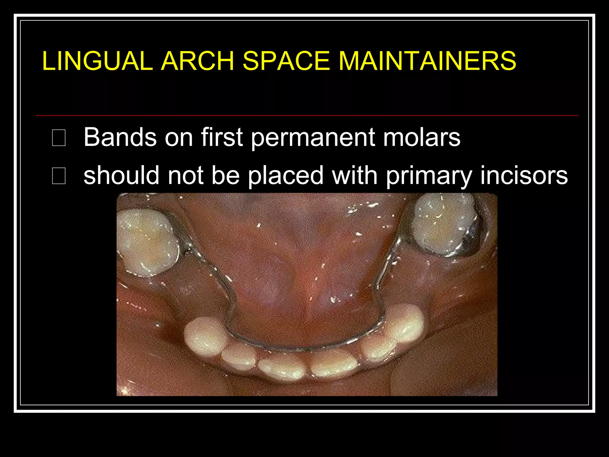 Space maintainer | PPT
