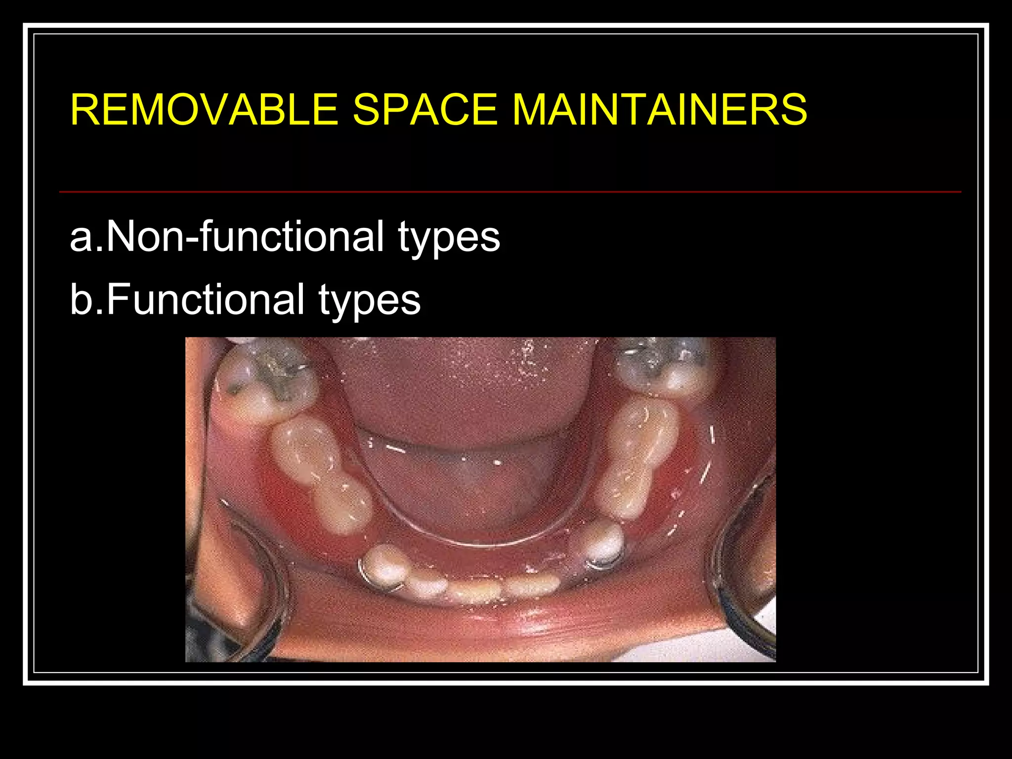 Space maintainer | PPT