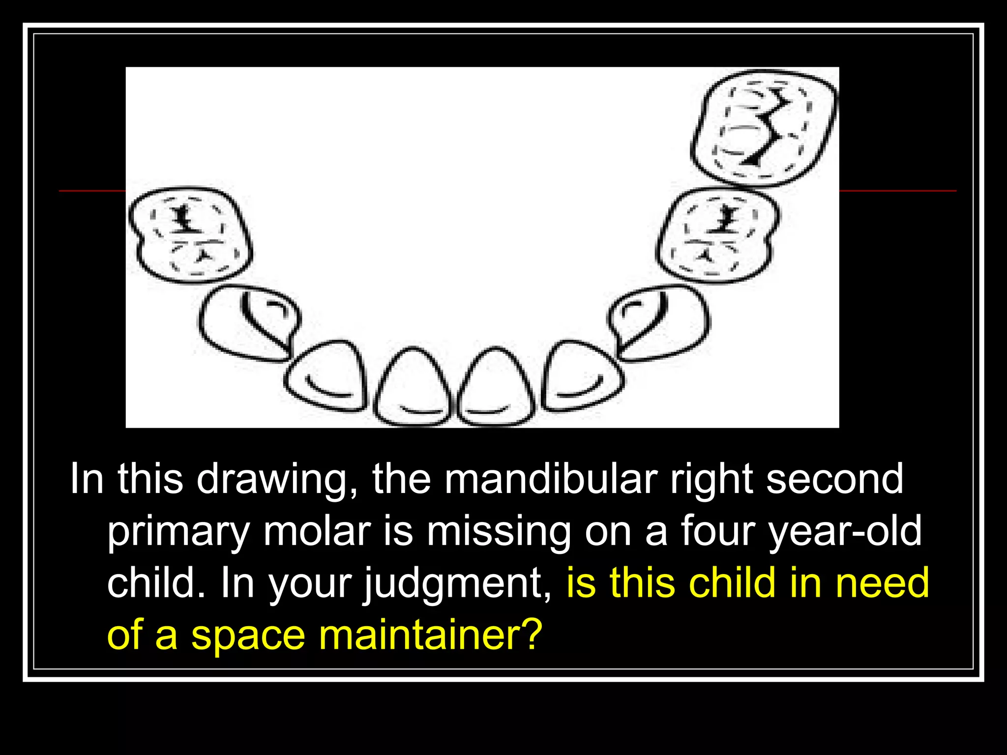 Space maintainer | PPT
