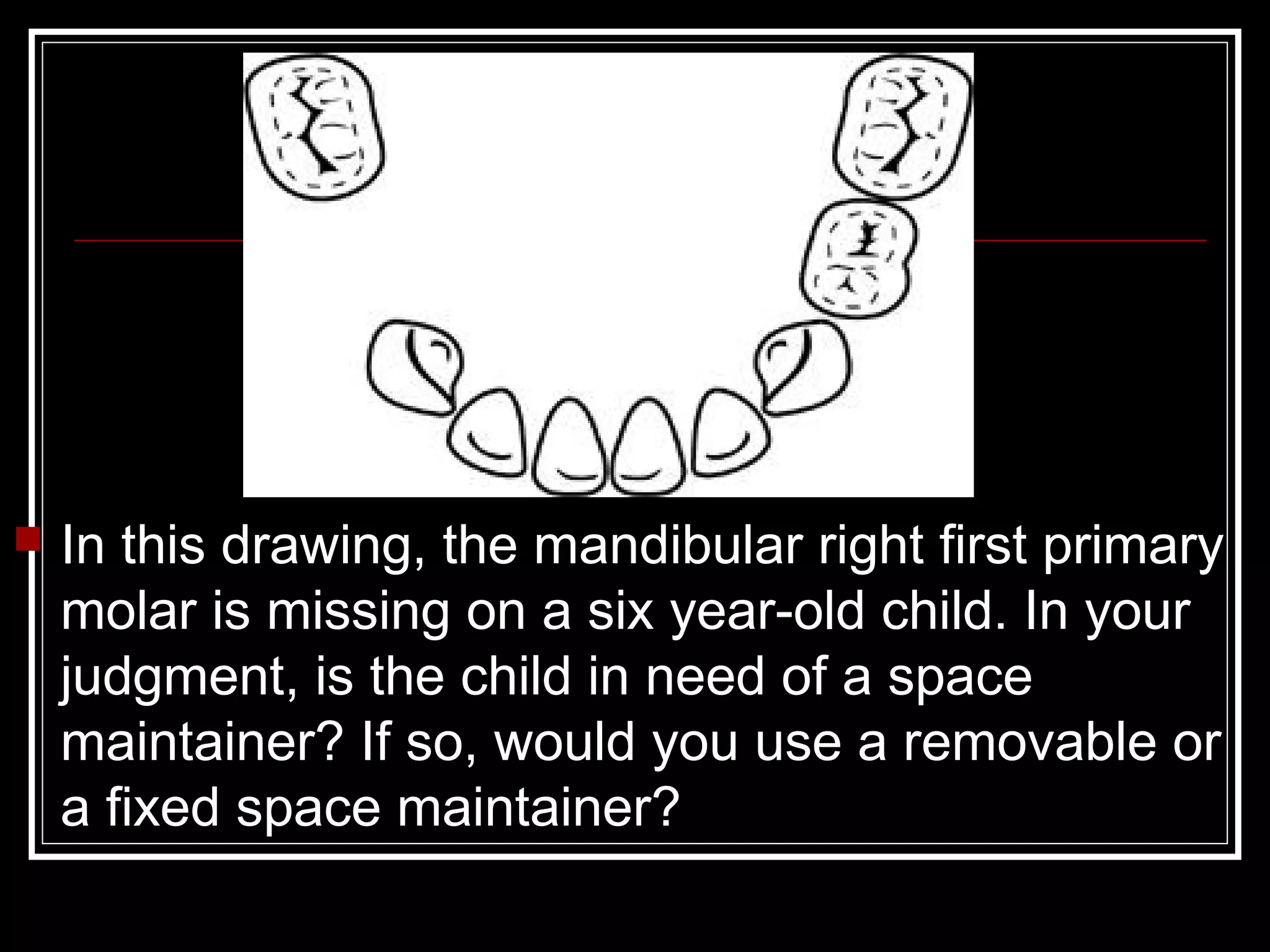 Space maintainer | PPT