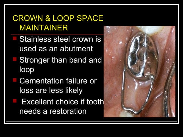 Space maintainer | PPT