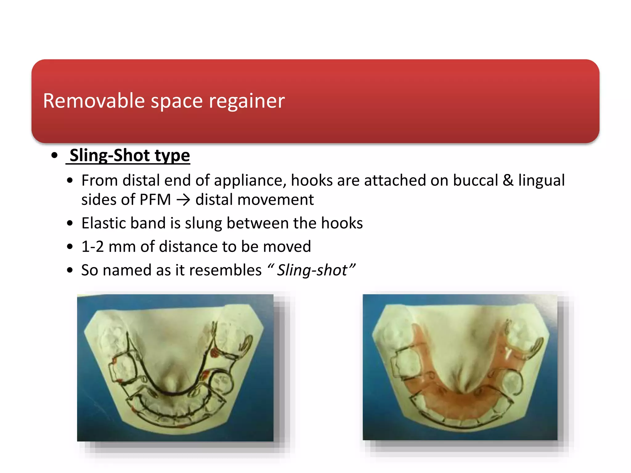 Space maintainers | PPTX