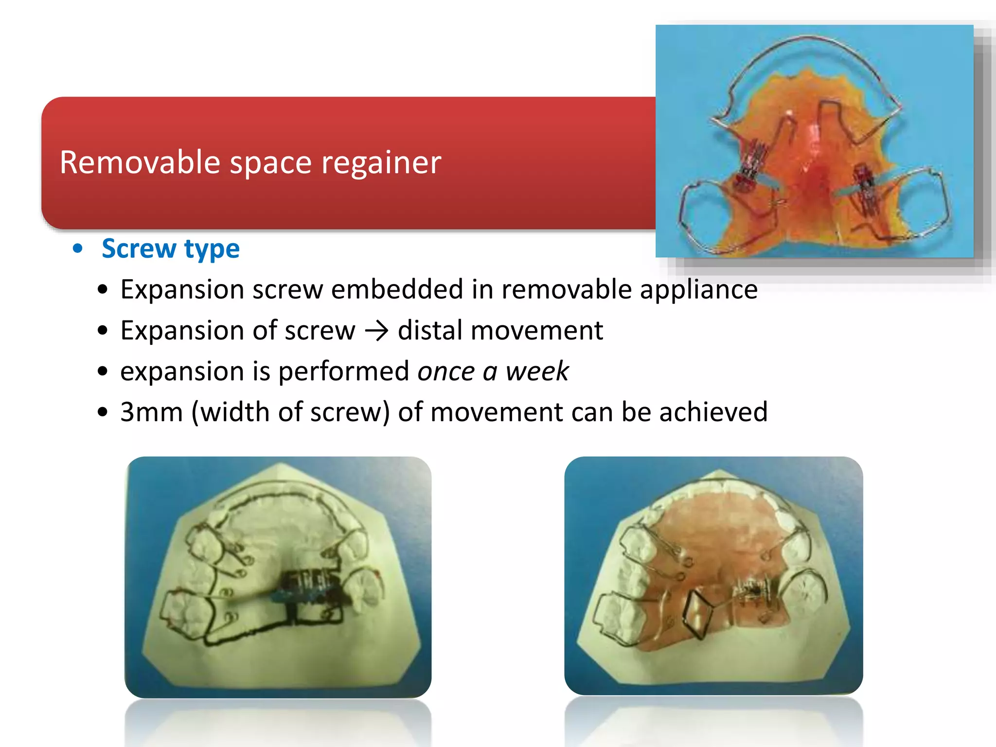 Space maintainers | PPTX