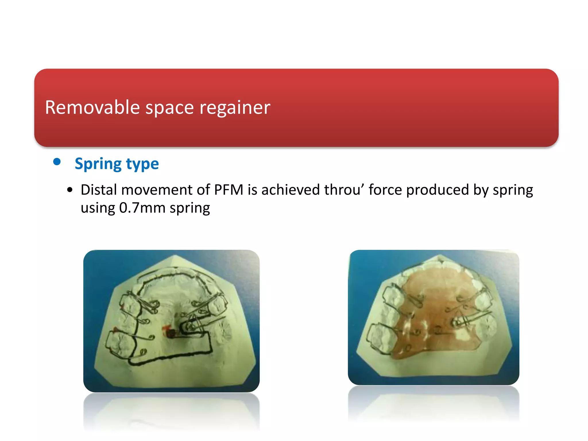 Space maintainers | PPTX