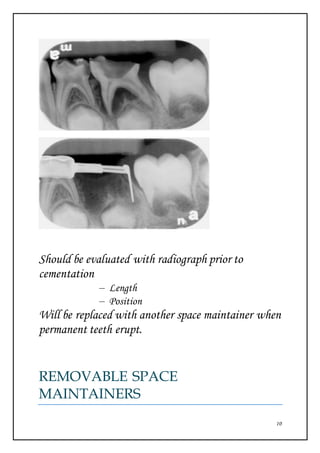 Space maintainers | DOCX